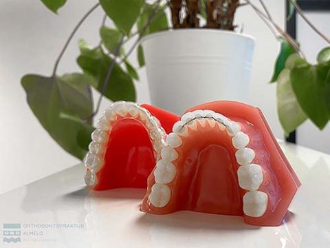 Soorten beugels - Orthodontiepraktijk Almelo