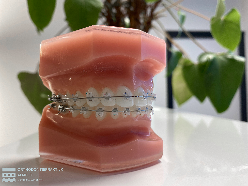 Slotjesbeugel - Orthodontiepraktijk Almelo | Uw orthodontist