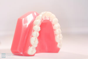 Soorten Beugels | Veel verschillende | Orthodontiepraktijk Almelo