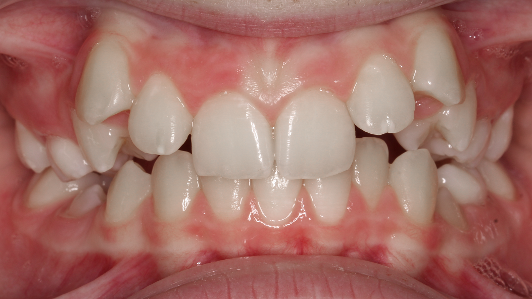 Behandelresultaten - Orthodontiepraktijk Almelo | Uw orthodontist