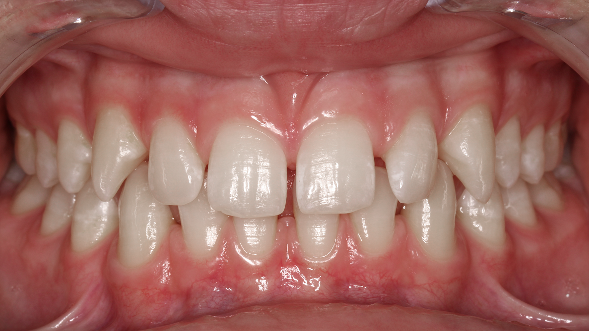 Behandelresultaten - Orthodontiepraktijk Almelo | Uw orthodontist